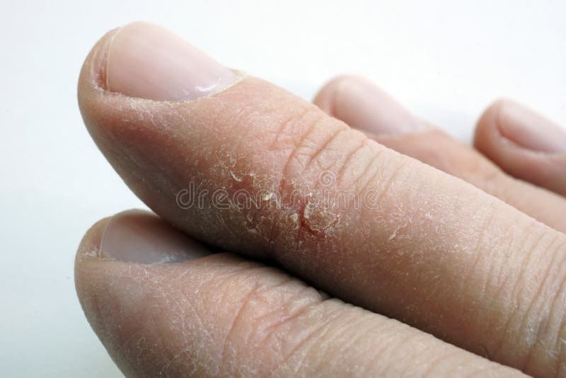 Dry Cracked Skin on Fingers. Fingers with Dermatology Problems Stock ...