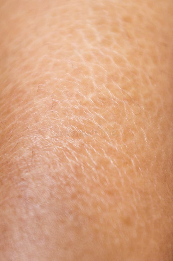 Xerosis Of Skin Is The Skin Prone To Dryness Or Is It Pathologically