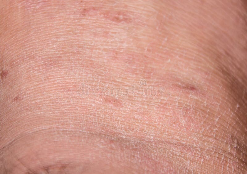 Dry Cracking Skin in the Winter Stock Image - Image of crack ...