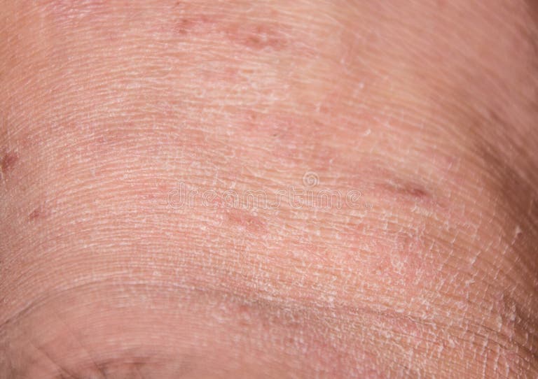 Dry Cracking Skin in the Winter Stock Image - Image of crack ...