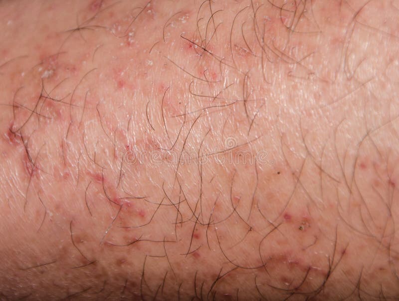 Dry Cracking Skin in the Winter Stock Photo - Image of feature, water ...