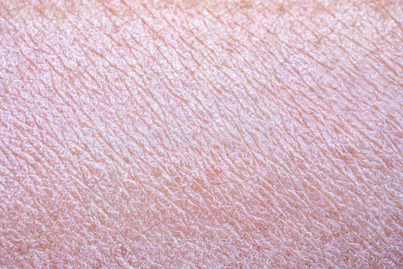 Dry and Dehydrated Human Skin Texture Stock Photo - Image of xerosis ...