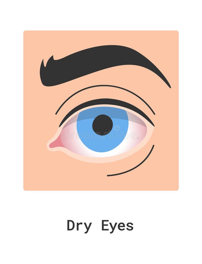 Dry Eyes Disease stock vector. Illustration of medicine - 276071840