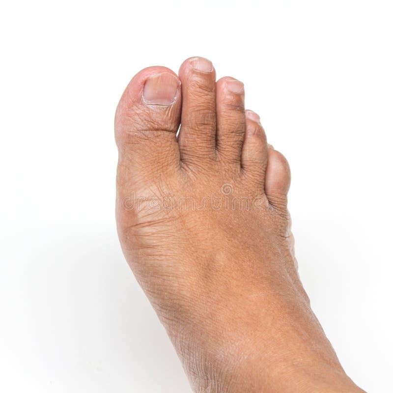 122 Dry Skin Big Toe Stock Photos - Free & Royalty-Free Stock Photos ...