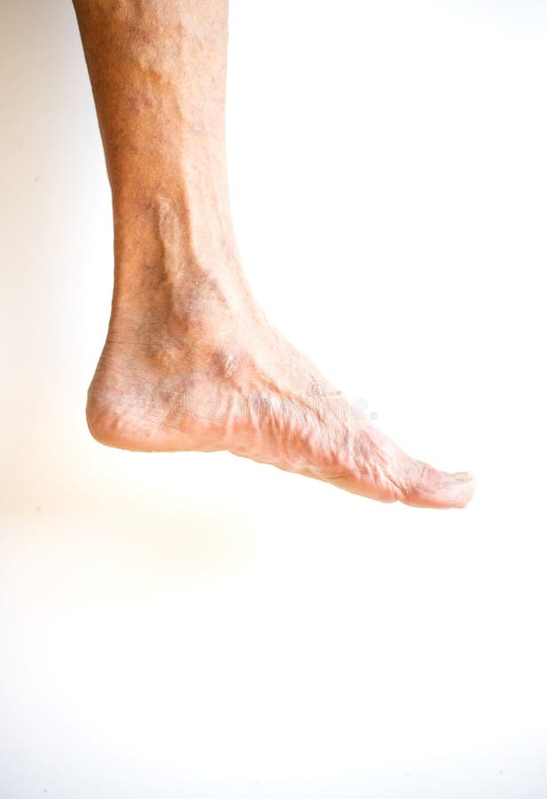 Dry, Rugged and Worn-out Feet of an Elderly Man on a White Background ...
