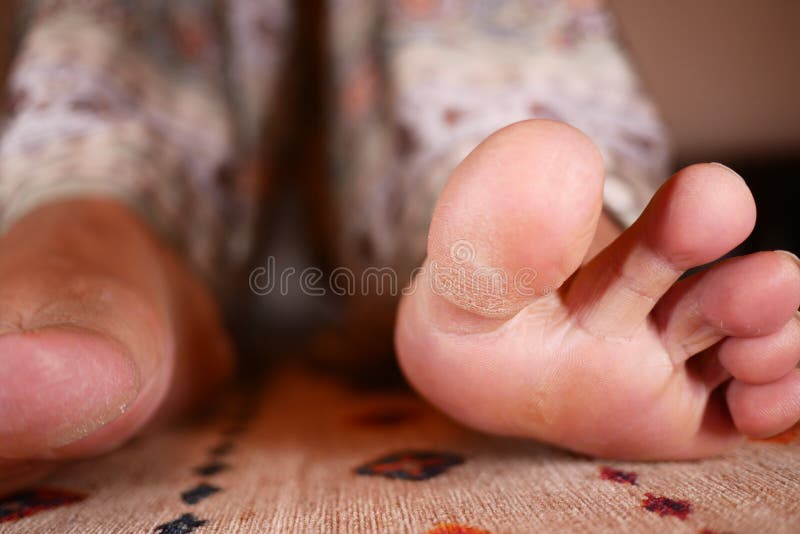 Dry Skin on Bare Feet on a Cozy Rug Stock Photo - Image of pampering ...