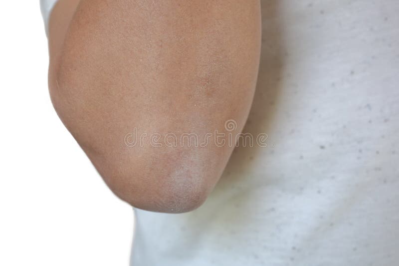 Dry Skin Condition on a Man Arm Stock Photo - Image of hygiene, crack ...