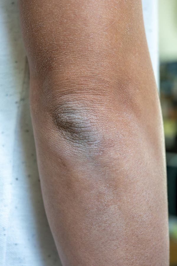 Dry Skin Condition on a Man Arm Stock Image - Image of cream, damaged ...
