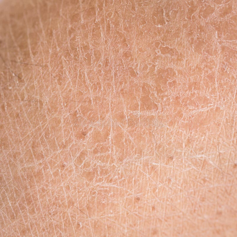 Dry Skin (ichthyosis) Detail Stock Photo - Image: 51469690
