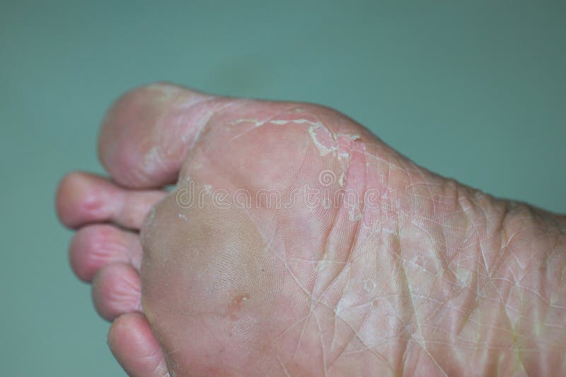 Dry Skin that is Peeling Feet Stock Photo - Image of infectiousness ...