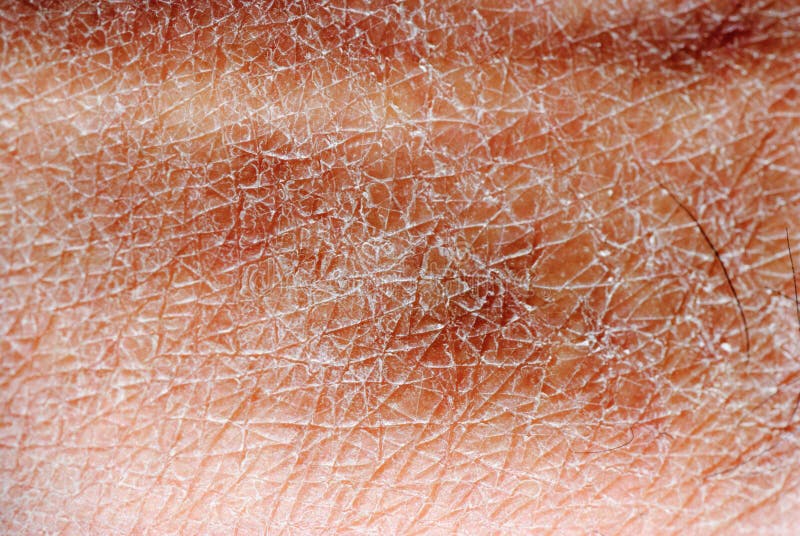 Dry skin texture stock image. Image of eczema, dermatitis - 18622837