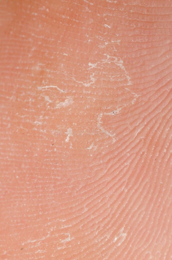 Dry skin texture stock image. Image of eczema, dermatitis - 18622837