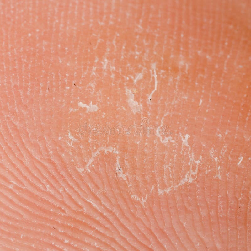 Dry skin texture stock image. Image of eczema, dermatitis - 18622837