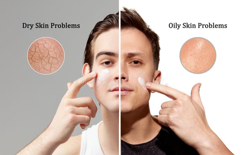 Dry Skin Vs Oily Ski Problems. Young Men with Different Skin Types ...