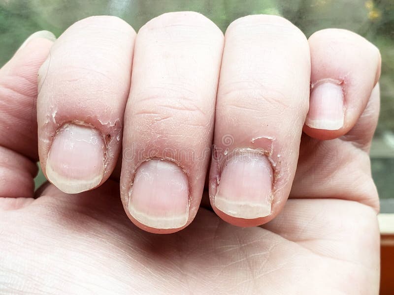 Dry Winter Hands in Need of Manicure. Stock Image - Image of cracked ...
