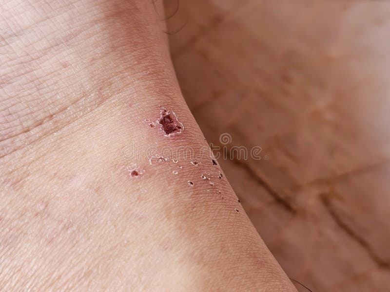 Dry Wound Caused by Itching of the Skin Stock Image - Image of care ...