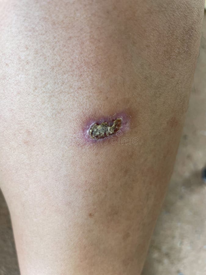 Dry wound on right leg stock photo. Image of patient - 252676756