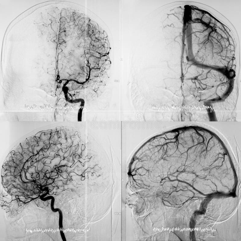 Brain Angiography, Arteriography Stock Photo - Image of patient, people ...