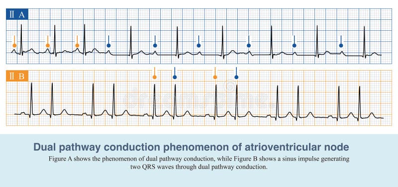 Dual Pathway Conduction Phenomenon of Atrioventricular Node Stock Photo ...