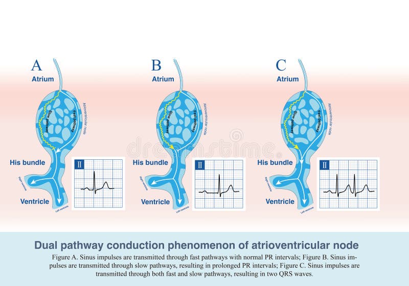 Dual Pathway Phenomenon of Atrioventricular Node Stock Photo - Image of ...