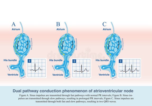 Dual Pathway Phenomenon of Atrioventricular Node Stock Photo - Image of ...