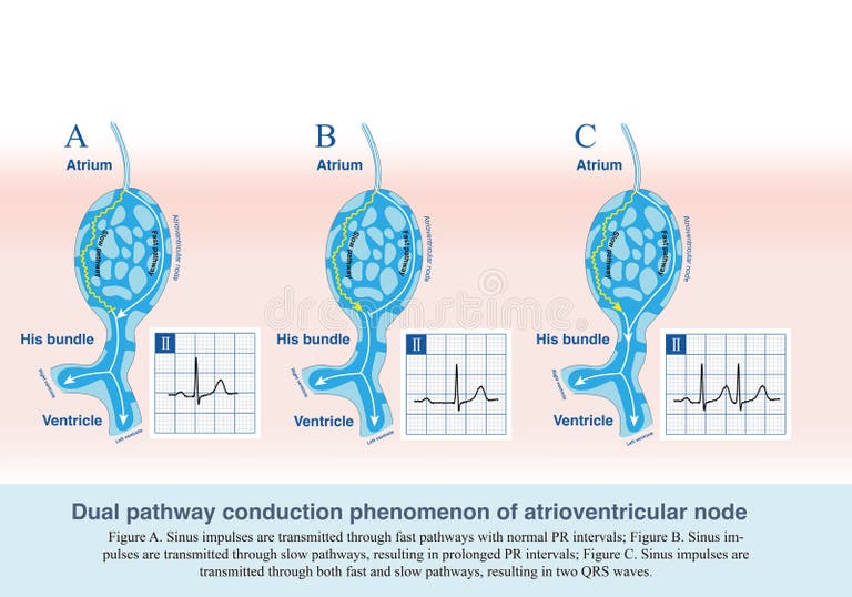 Dual Pathway Phenomenon of Atrioventricular Node Stock Photo - Image of ...