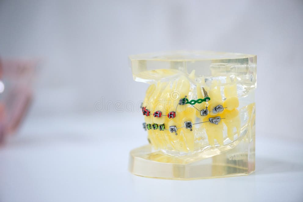 Mock Teeth with Braces. Demonstration Model of Teeth Editorial Image ...