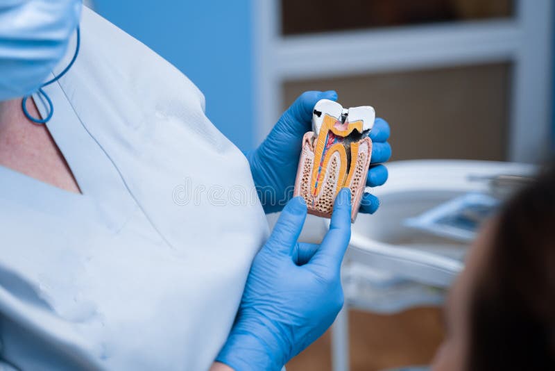 Dummy of a Sick Tooth with Caries, Dentist Shows Structure of the Teeth ...