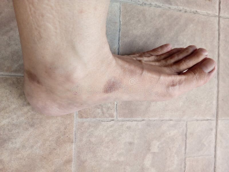 Hautwunde Mit Kruste Nach Laser-Behandlung Stockfoto - Bild von kruste ...