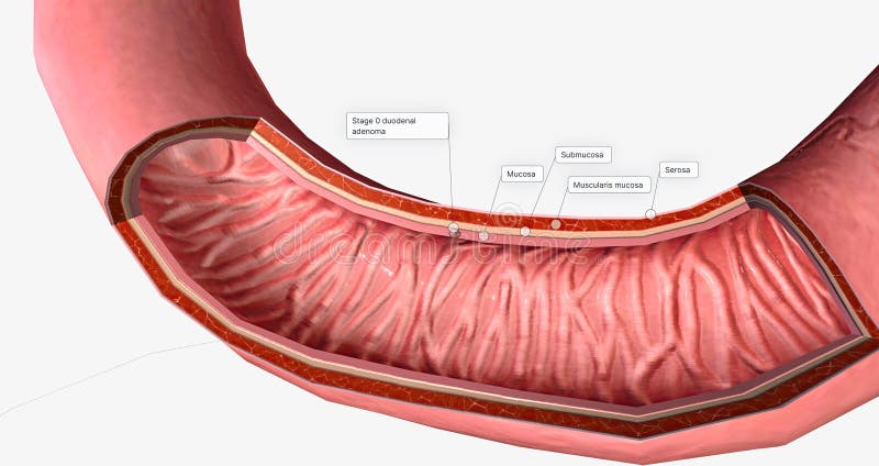 The Duodenal Carcinoma, Stage 0 3d Stock Illustration - Illustration of ...