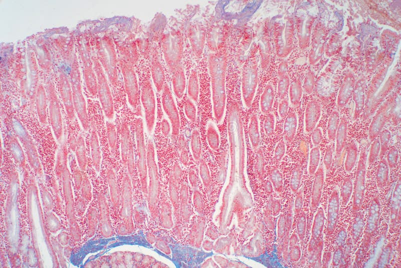 Duodenum Biopsy from the Pathology of Small Intestine Stock Image ...