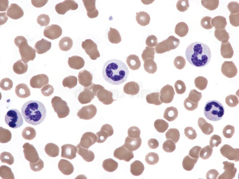 Myelodysplastic Syndromes Stock Photos - Free & Royalty-Free Stock ...