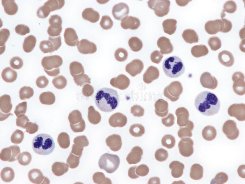 Dysplastic Changes in Neutrophils. Stock Image - Image of neutrophil ...