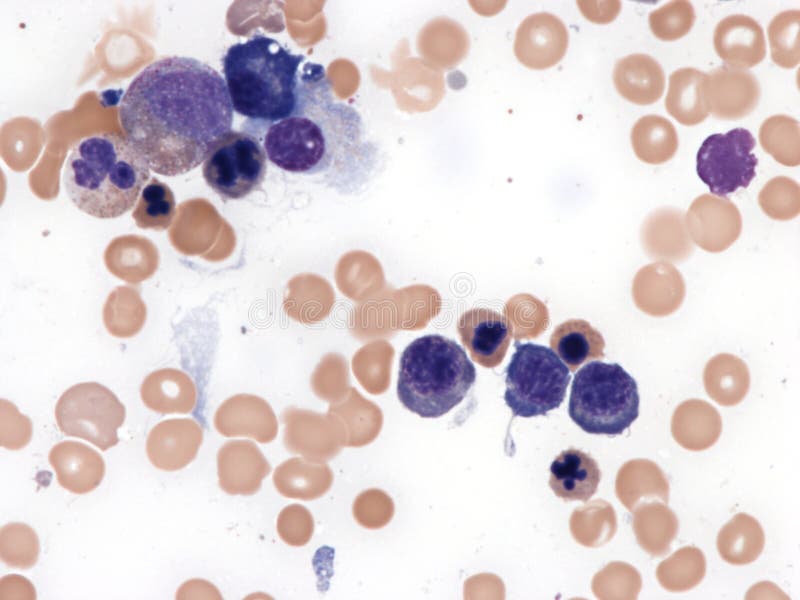 Dysplastic Erythroblasts in Bone Marrow. Stock Photo - Image of medical ...