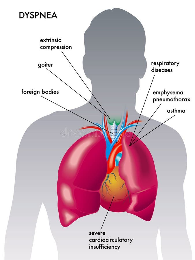 Patienten Mit Dyspnoe, Atemloses Farbiges Piktogramm Vektor Abbildung ...