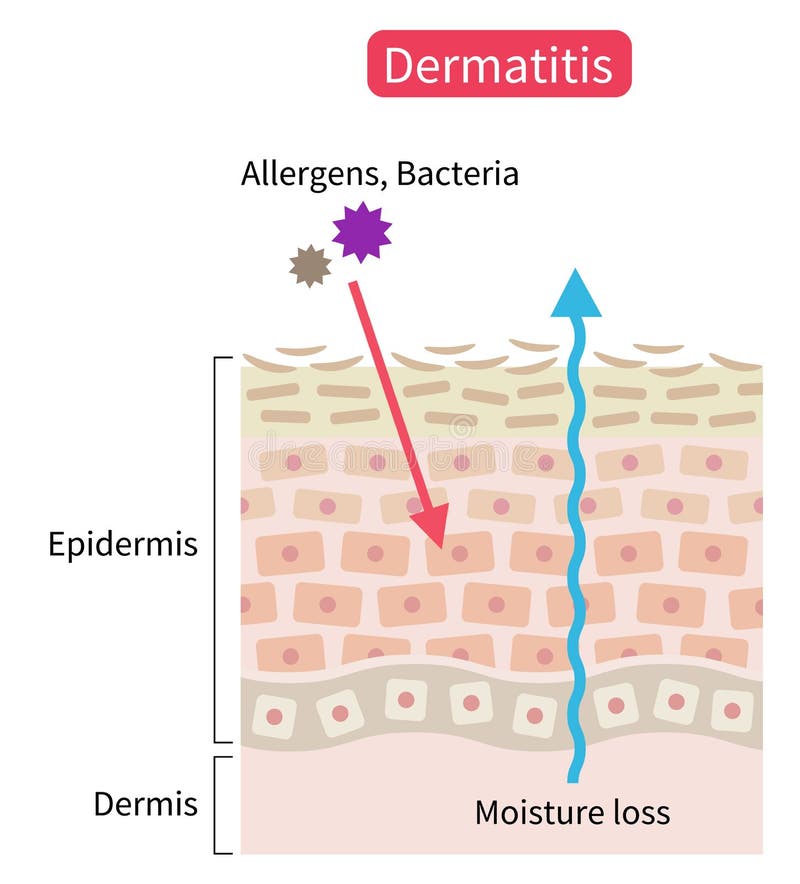 Atopic Dermatitis Eczema Skin Disrupt Moisture Barrier that Allows ...