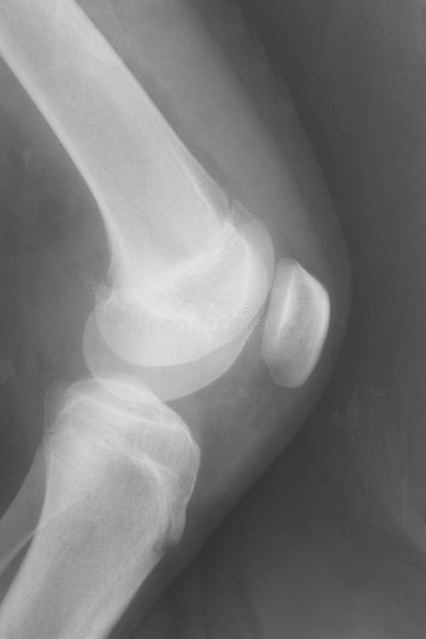 Human Knee-joint with Kneecap on X-ray Image Stock Image - Image of ...