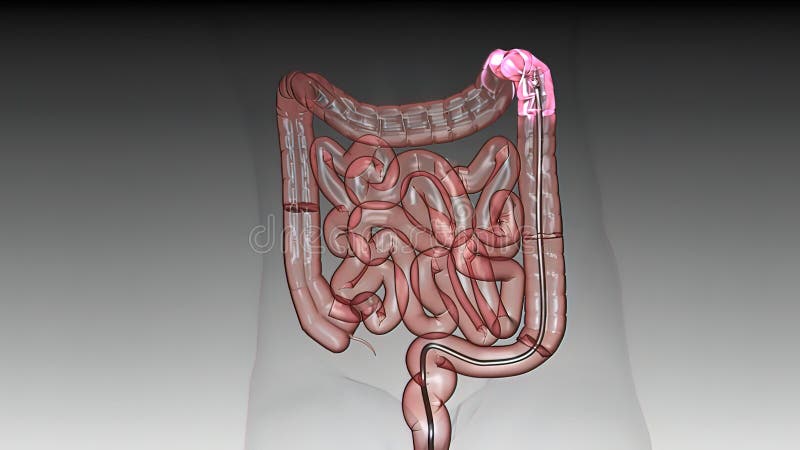Eamination of the Large Intestine Under Amonitor with a Fiberoptic ...