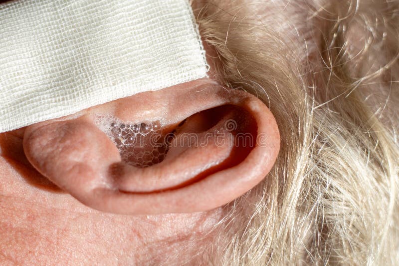 Ear Diseases. Dropping Hydrogen Peroxide into a Man& X27;s Ears To ...