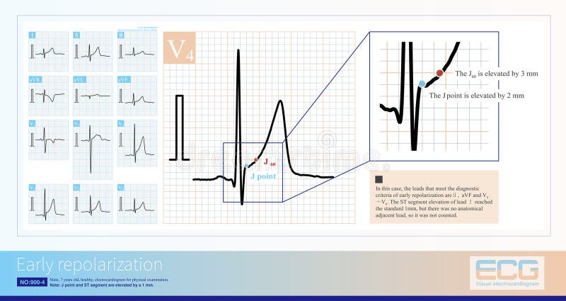 Early repolarization stock photo. Image of arrhythmias - 347480286