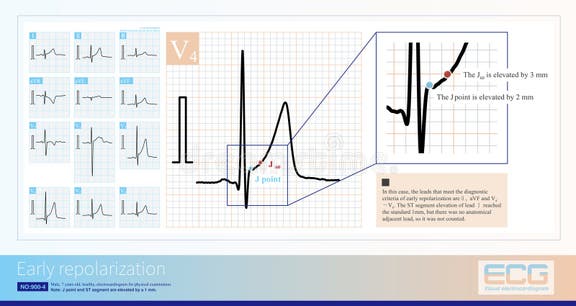 Early repolarization stock photo. Image of arrhythmias - 347480286