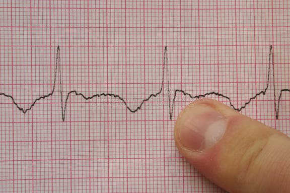 14,993 Asistolia Ecg Stock Photos - Free & Royalty-Free Stock Photos ...