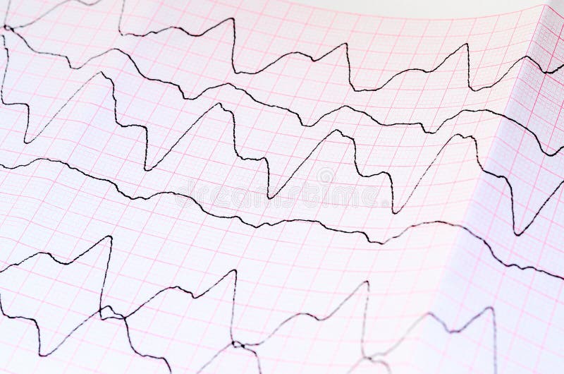 ECG-band Met Paroxysmal Ventriculaire Hartkloppingen Stock Afbeelding ...