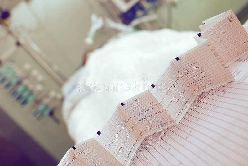 ECG Chart on the Background of the Patient Bed Stock Image - Image of ...