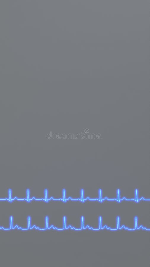 Comparison of ECG of Normal Heart Rhythm and Bradycardia. Stock ...