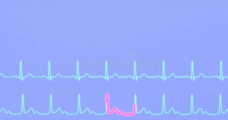 ECG Comparison of Normal Heart Rhythm and AV Block. Animation 3D Render ...