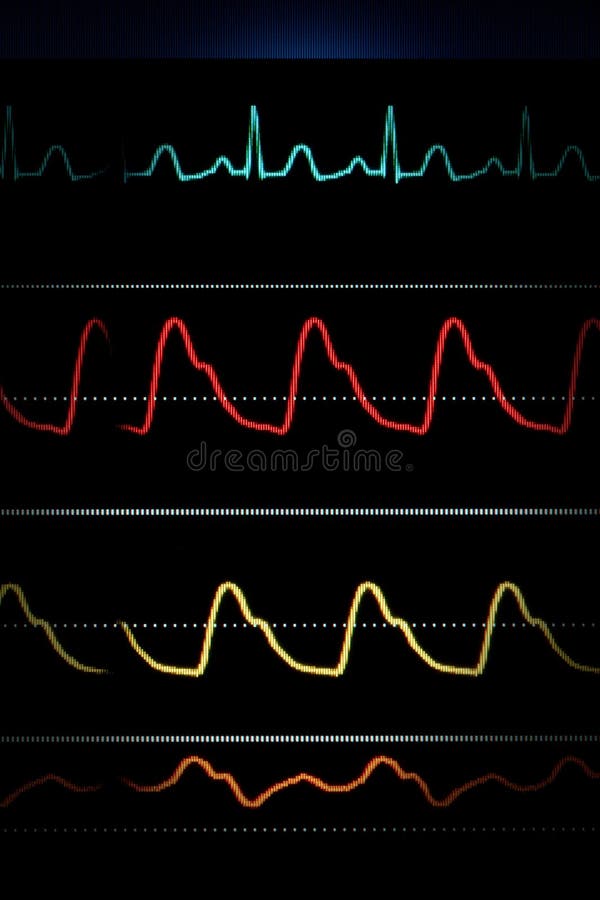 ECG Curves on the Heart Monitor Stock Image - Image of medical ...