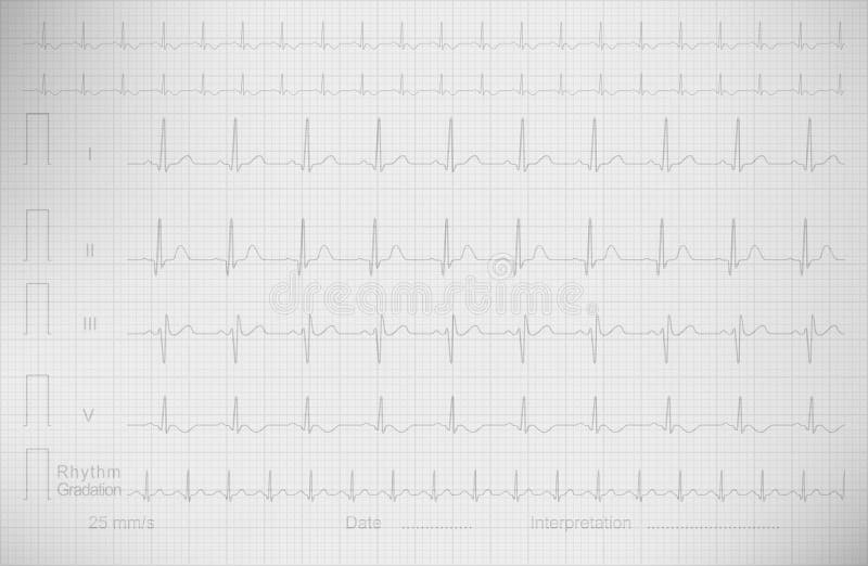 ECG Drawing on the Square Paper, Vector Stock Illustration ...