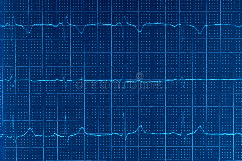 ECG Electrocardiogram stock illustration. Illustration of amplitude ...
