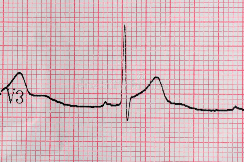 Normal ECG stock photo. Image of healthcare, screen, cardiologist - 1842238